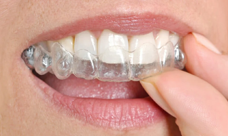 Daily Invisalign Routines That Work For Durham Patients - Digital ...